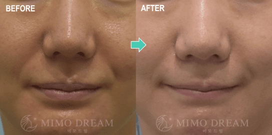 큐어젯(Cure-Jet) | 바늘없는 주사 - 모공, 흉터, 튼살, 탈모, 안티에이징 치료 - 미모드림의원